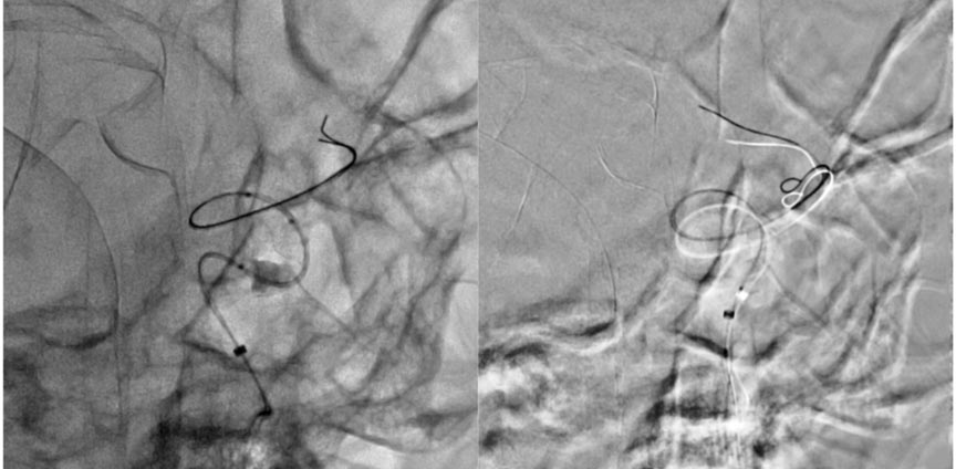"Twisted" flow diverter resolved by "balloon-assisted technique"