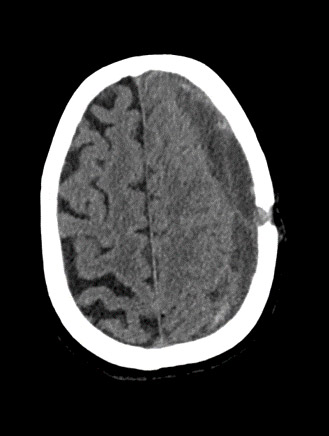 MMA embolization of a 79-year-old patient